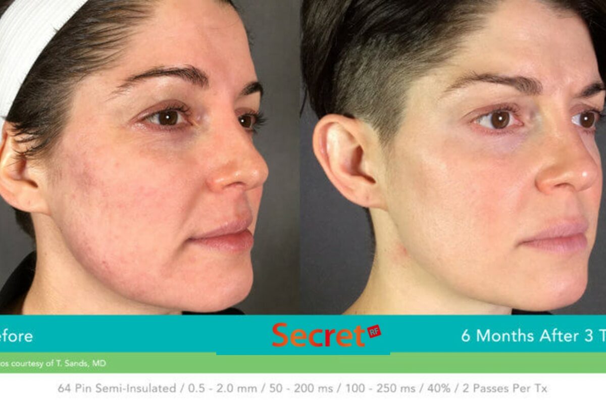 Secret RF - Akademikliniken®