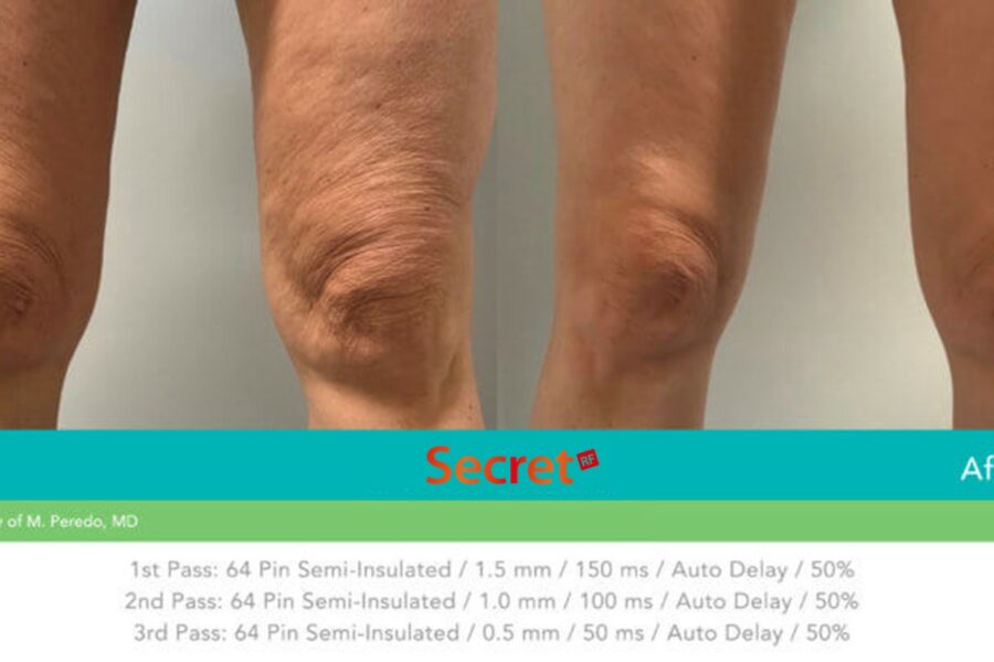 Secret RF - Akademikliniken®